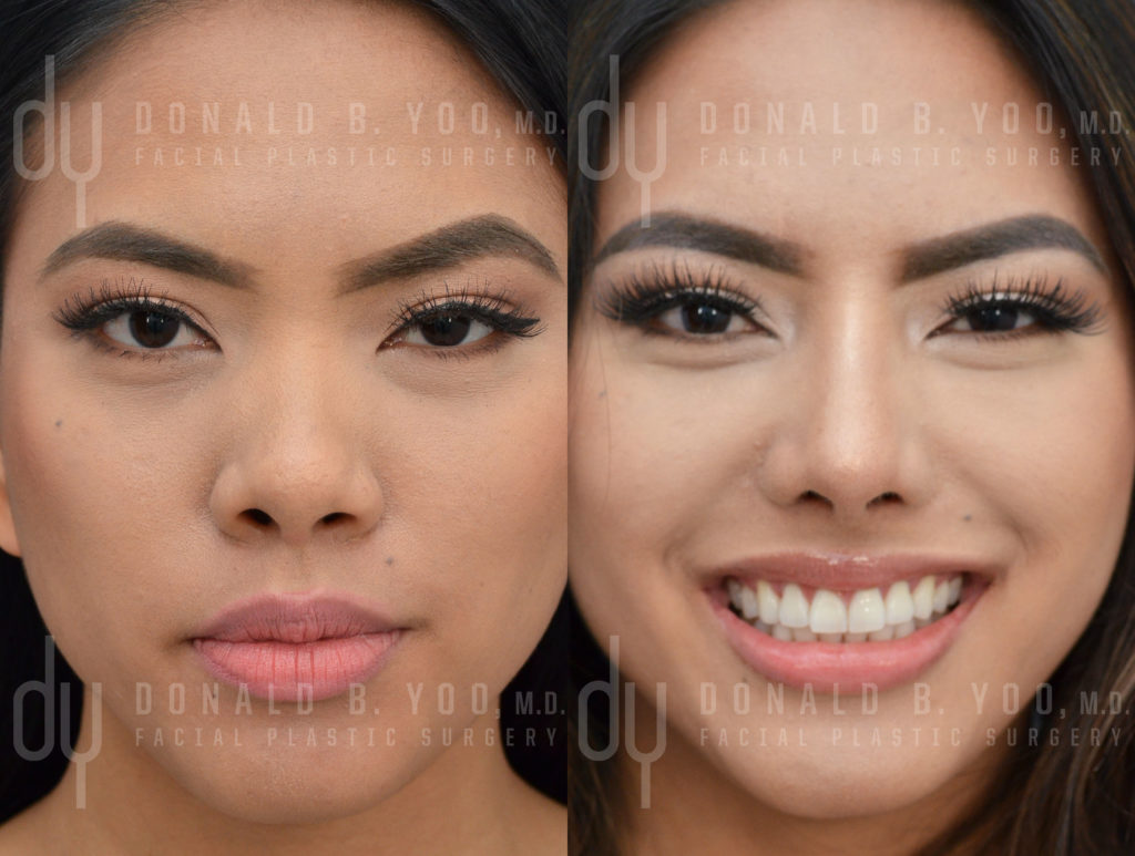 History of Asian Rhinoplasty and Asian Nose Job Surgery – Asian Rhinoplasty